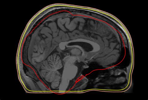 Bug Problematic Surfaces Extracted Using Watershed · Issue 5565 · Mne