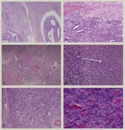 New Developments In Endometrial Stromal Sarcoma Diagnostic Histopathology