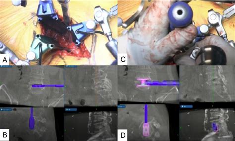 Navigated Expandable Cage T2 Stratosphere Tm Expandable Corpectomy