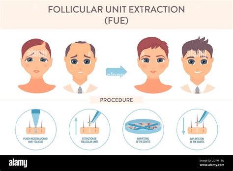Follicular Unit Extraction Fue Surgery Conceptual Illustration Stock