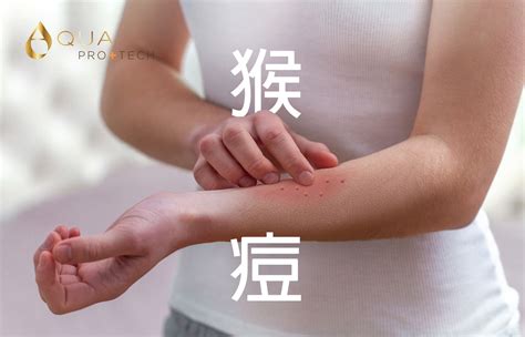 猴痘蔓延至31個國家 一文睇清猴痘病毒 Aqua Protech