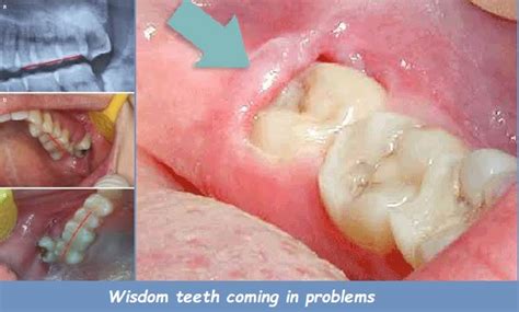 Normal Wisdom Teeth Growth Wisdom Teeth The Treatment Centre
