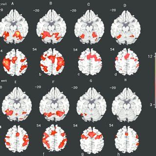 PDF Motor Cortex Activation During Motor Imagery Of The Upper Limbs In Stroke Patients