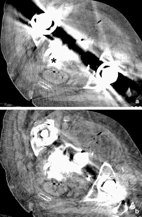 Improved Image Quality Using Metallic Artifact Reduction Mar