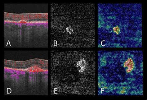 Nonexudative Neovascular Age Related Macular Degeneration Seen On Octa Download Scientific