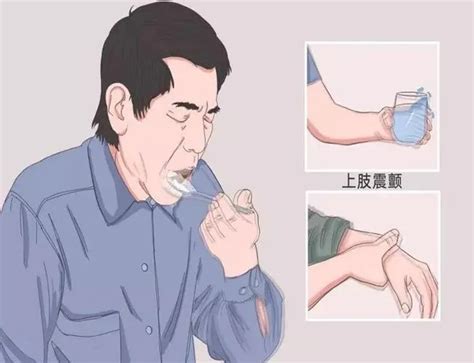 这样的手抖是不是帕金森病而是特发性震颤 刘亚丽主治医师 爱问医生