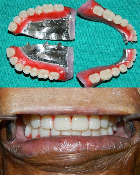 Swing Lock Denture