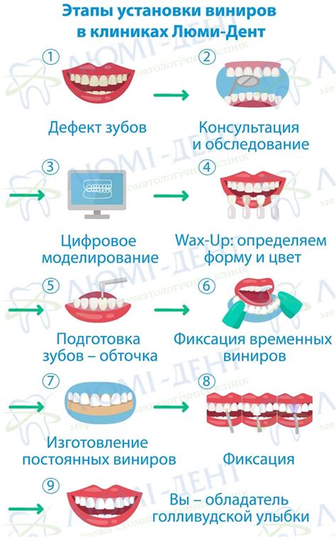 Виниры цена Киев за 1 зуб- Люми Дент Позняки Оболонь Соломенский район