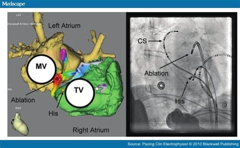 Mapping And Ablation Of Atypical AVNRT