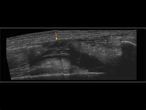 Quadriceps Tendon Rupture Image Radiopaediaorg