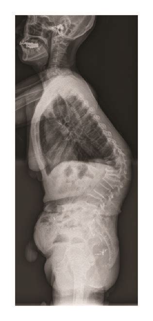 Illustrative Case Using Femoral Shaft Allograft For Correction Of Download Scientific Diagram