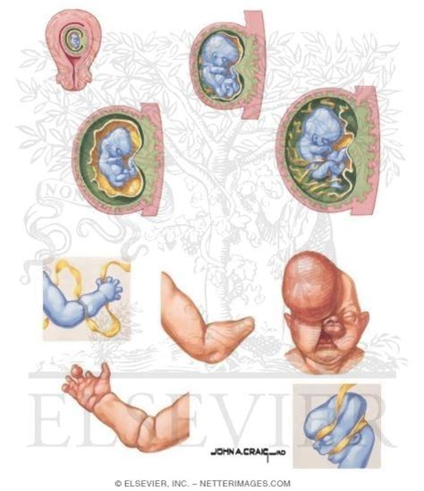 Anomalies Causd By Amniotic Rupture