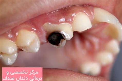 پوسیدگی دندانکرم خوردگی پوسیدگی نوعی خرابی دندان است و زمانی اتفاق می