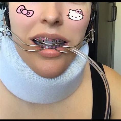 Pin By Jamie Richie On Braces And Retainers Orthodontics Teeth Braces Dental Braces Braces