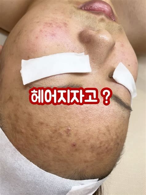 가다듬에스테틱 부산면봉잡이 Aka 씨털이범 여드름압출 서면여드름 여드름흉터 부산여드름수강 𝔾𝕒𝕕𝕒𝕕𝕖𝕦𝕞 가다듬 ⠀⠀⠀⠀⠀⠀⠀⠀⠀⠀⠀⠀⠀⠀ “여드름 압출 정말