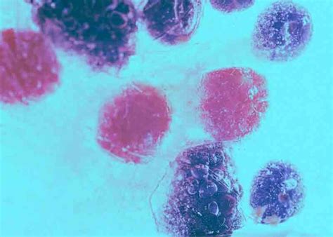 Causes And Risk Factors Of Monocytosis Klarity Health Library