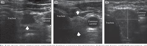 Pdf Post Thyroidectomy Neck Ultrasonography In Patients With Thyroid