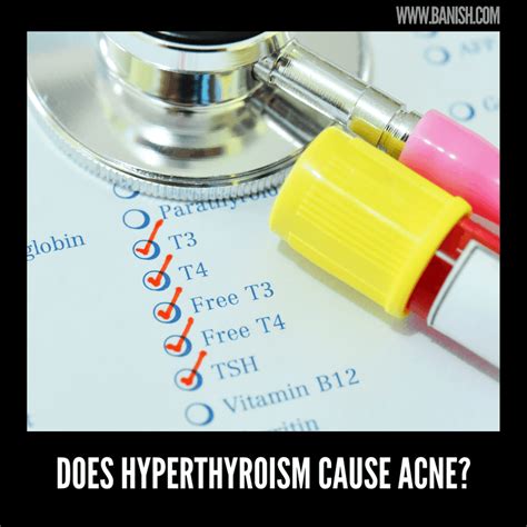 Does Hyperthyroidism Cause Acne Banish