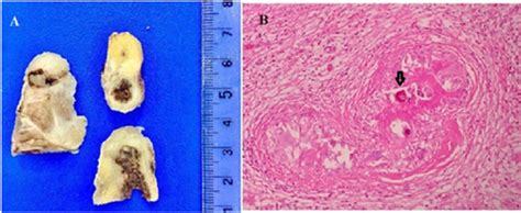 A Gross Picture Of The Inflamed Appendix Showing Luminal Obstruction Download Scientific