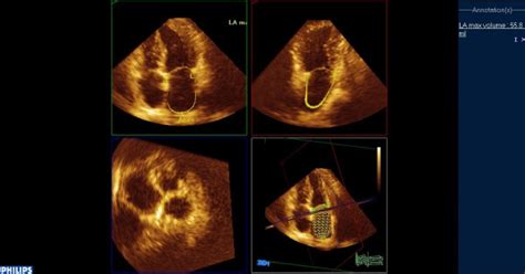 Assessment Of La Volumes Using Rt3de Automatic Border Detection Is Download Scientific Diagram