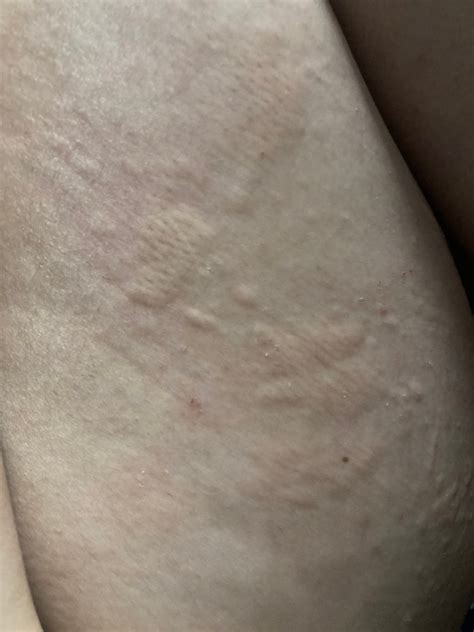 피부 두드러기 지식in