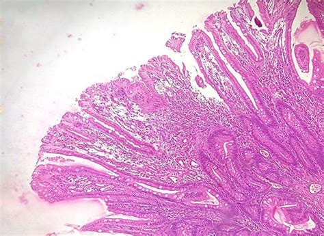 The Polypoidal Structures From The Resected Segment Of The Bowel Were