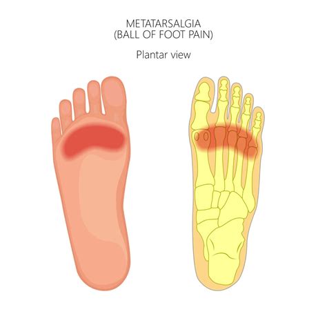 Dolor En El área Metatarsal Del Pie Causas Y Tratamiento Tu Salud