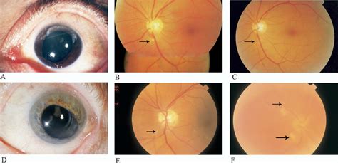 Patient 1 A Anterior Segment Photograph Showing Sectorial Iris Download Scientific Diagram