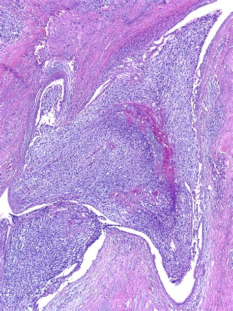Phyllodes Tumor Mgh Learn Pathology