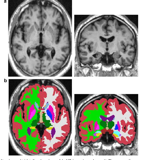 Figure 1 From Hierarchical Statistical Shape Analysis And Prediction Of