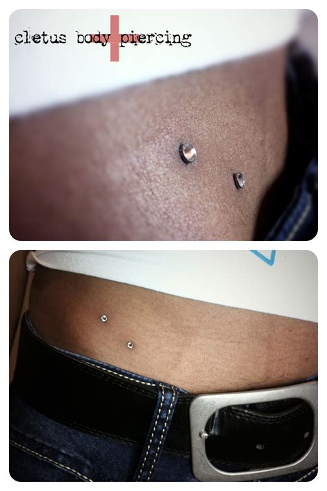 2 Weeks Healed Double Hip Surface Anchor Microdermal Titanium 4mm