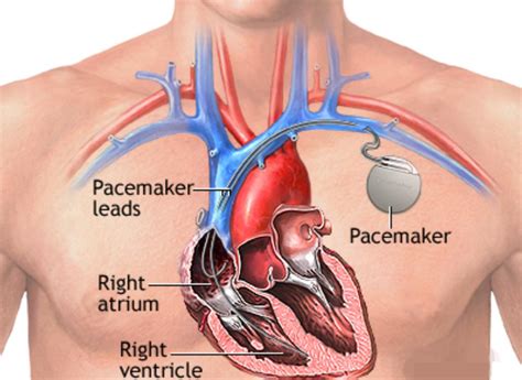 Pacemaker Implantation Dr Ravi Gupta