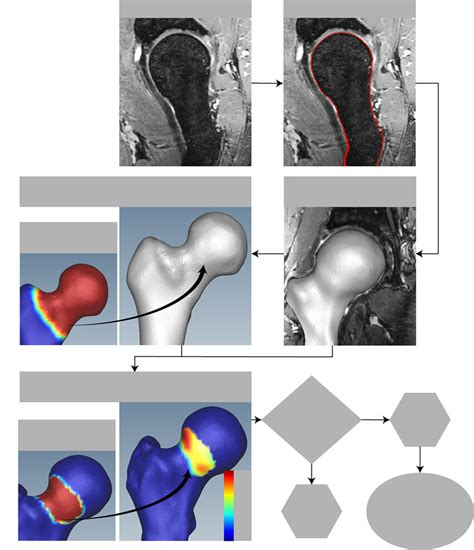 The Cammorph Pipeline Involving Segmentation Of The Proximal Femur And