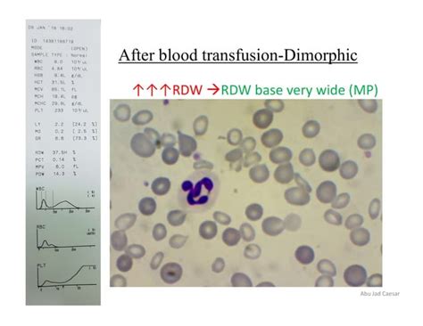 Rbc Histogram Ppt