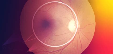 Overview Of The Fixed Duration Epcoritamab R Mini Chop In Patients With Previously Untreated