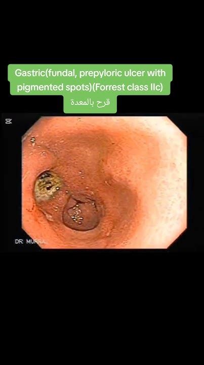 Gastric Ulcers Forrest Class Iic قرحبالمعدة Hepatic Digestivedisease اكسبلور