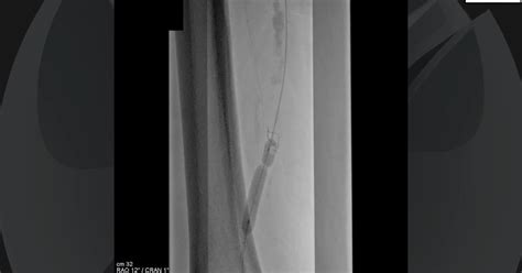 Piper Bypass Ivus Guided Totally Percutaneous Femoral Popliteal