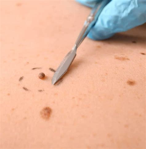 Safe Skin Tag Removal In Singapore Treatments And Price 1aesthetics