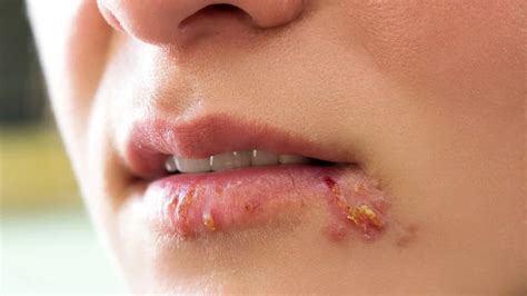 Hsv1 Vs Hsv2 Differences In Diagnosis Treatment And More Goodrx