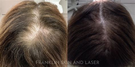Hair Restoration Before And After Photos In Franklin