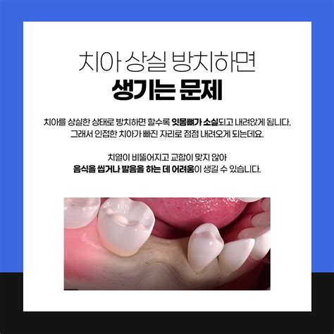 치과 임플란트 수명 얼마나 될까요 임플란트 오래 사용하려면 네이버 포스트