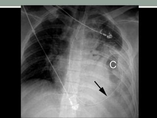 Imaging Of Diaphragmatic Rupture Pptx