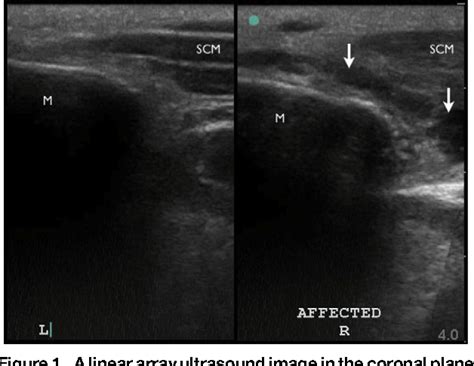 Figure 1 From Diagnosis Of Bezold Abscess Using Bedside Ultrasound