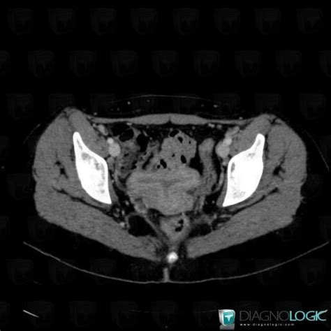 Cas Radiologie Ectopie Rénale Croisée Scanner Diagnologic