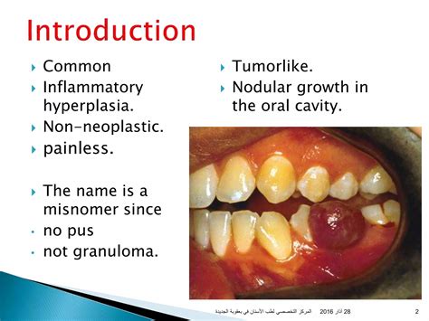 Oral Pyogenic Granuloma Pptx