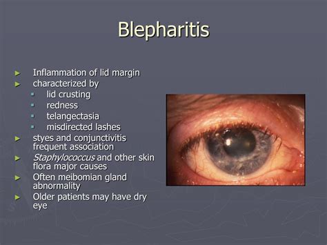 Blepharitis Vs Conjunctivitis My Xxx Hot Girl