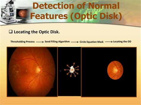 automatic detection of diabetic maculopathy from funduas images using