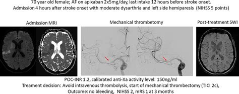 Patient Selection Using Doac Monitoring — Avoid Ivt If Calibrated Download Scientific Diagram