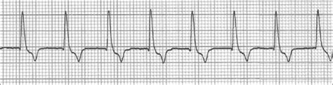 Hyperkalemia Ecg Cat
