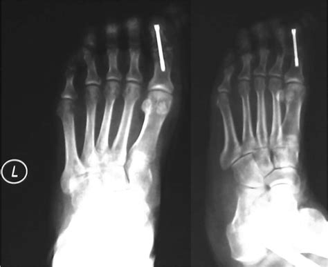 Arthrodesis For Treatment Of Intra Articular Synovial Cysts Of The